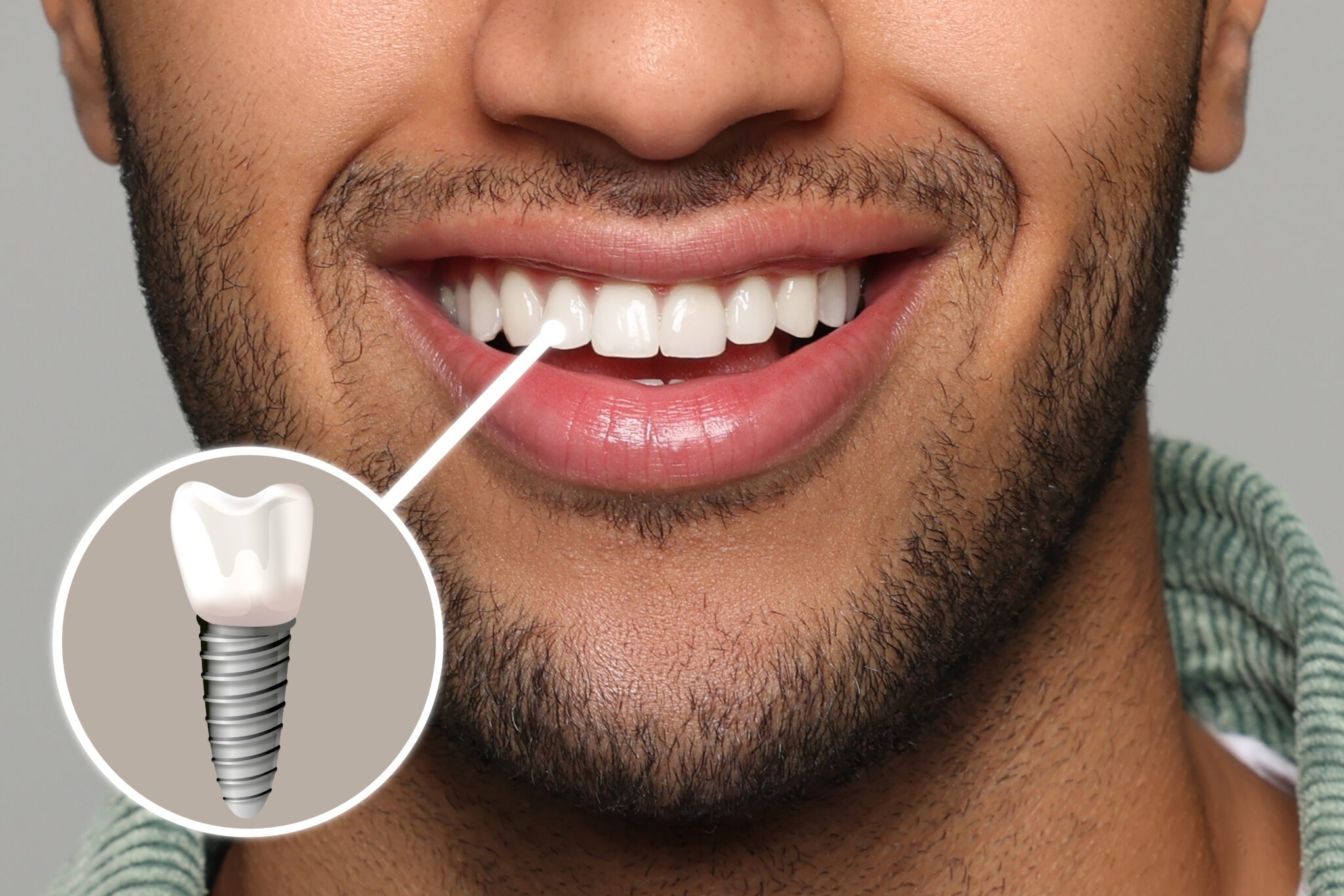 5 Amazing Ways Dental Implants Transform Your Smile and Fill Missing Gaps